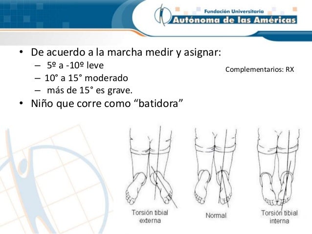 Torsión tibial interna y pie plano