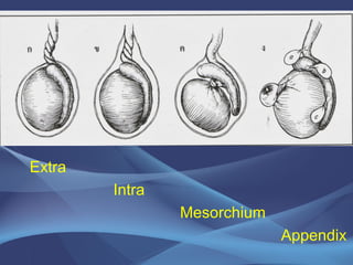 Testicular torsion, төмсөг мушгирах | PPT