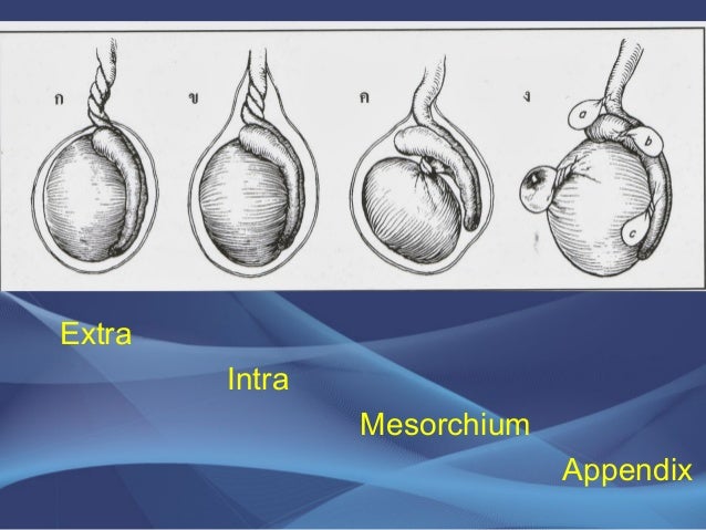 Testicular Torsion testicular-torsion