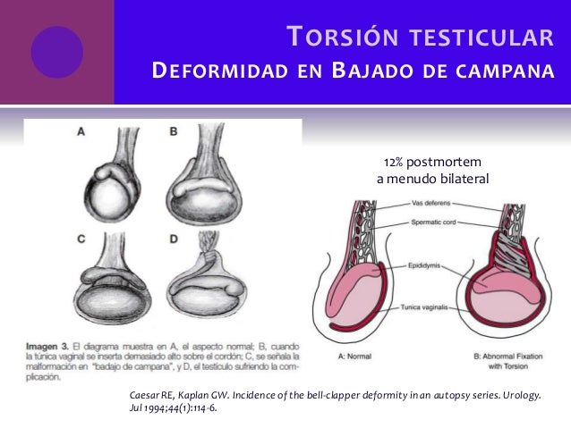Torsion testicular