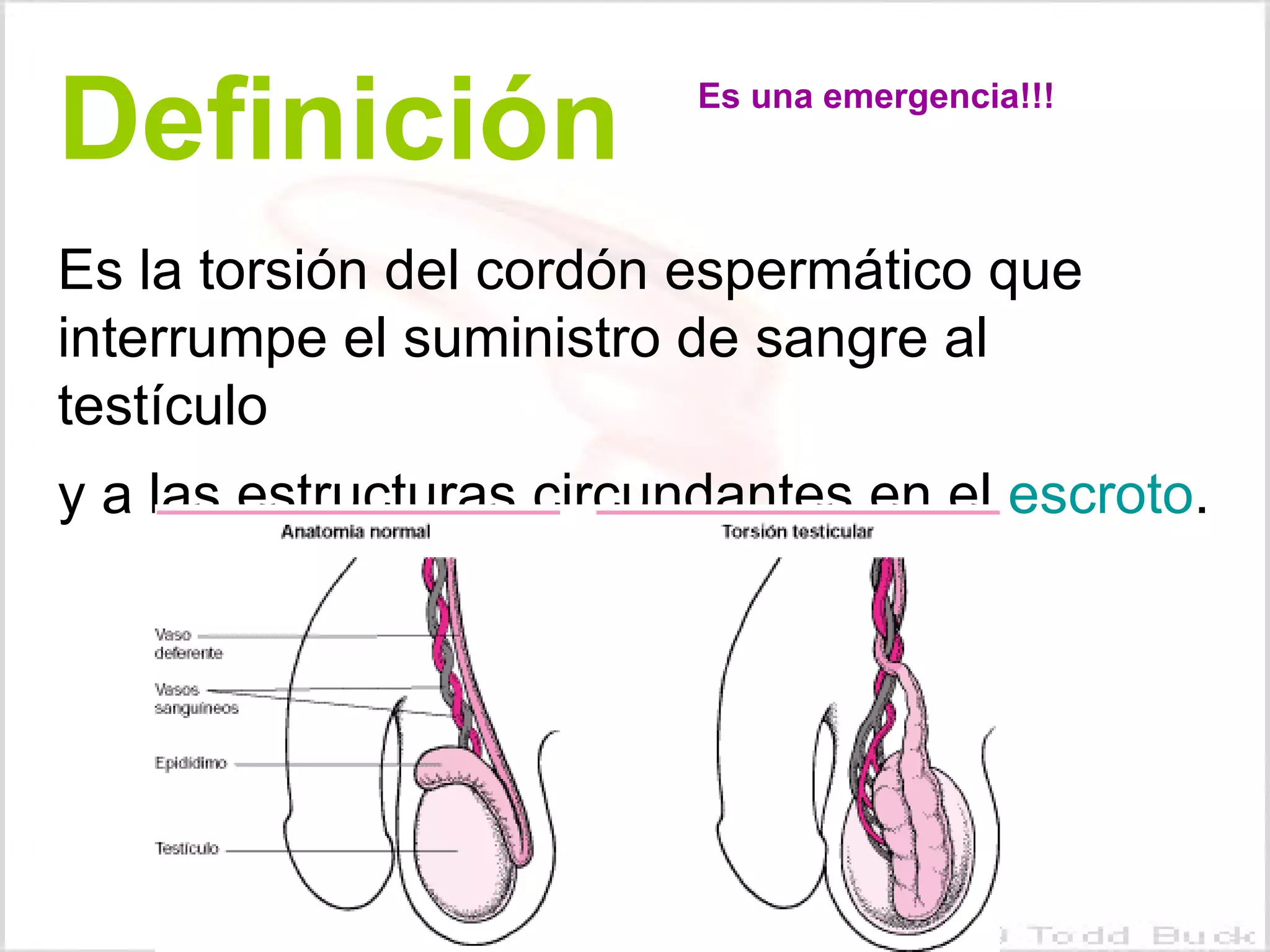 Torsion Testicular Ppt