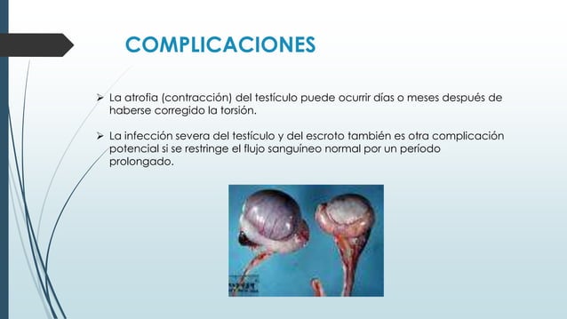 Torsion Testicular Y Epididimitis Ppt
