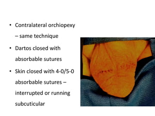 Torsion testis - Operative chat | PPTX