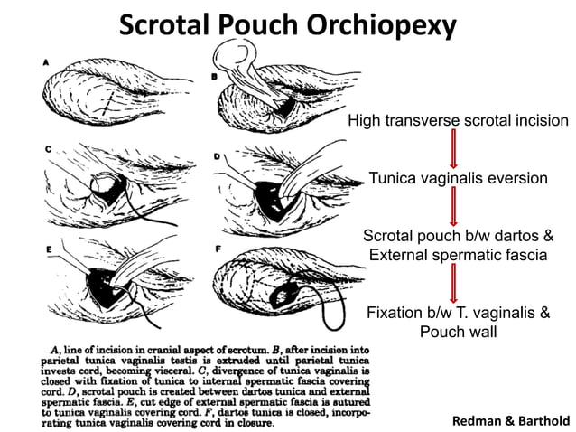 Torsion testis - Operative chat | PPTX
