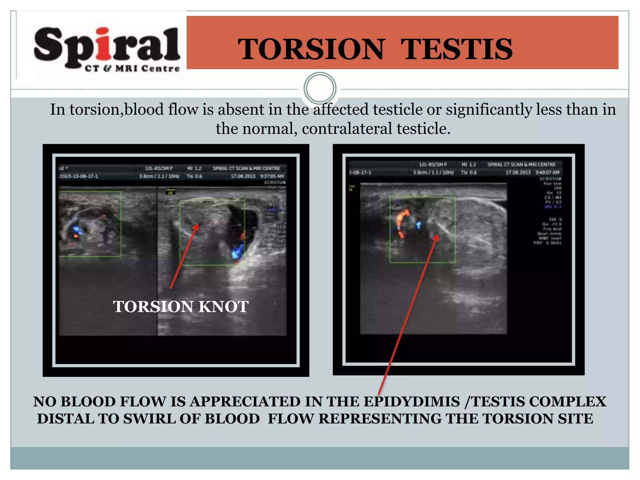 Torsion testis final | PPTX