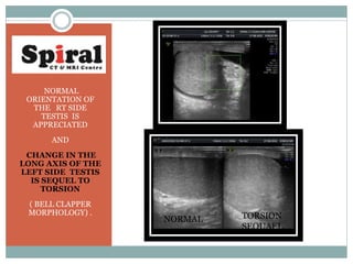 Torsion testis final | PPTX