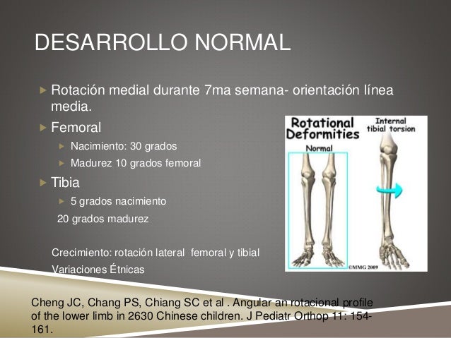 Normal Tibial Torsion