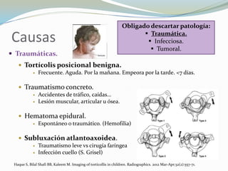 Tortícolis adquirida en pediatría. Evaluación en urgencias. Miriam Nova ...