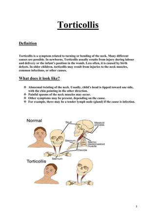 Torticollis | DOCX