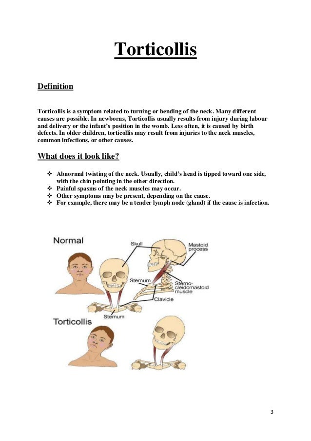 Torticollis