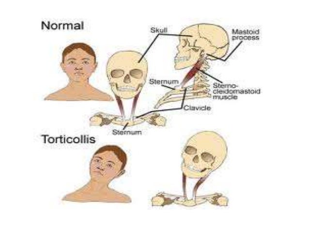 Torticollis