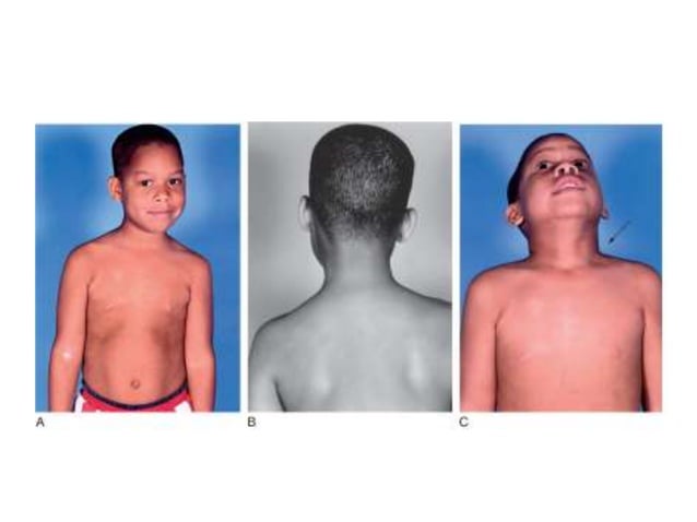Torticollis | PPTX | Pregnancy | Reproductive Health