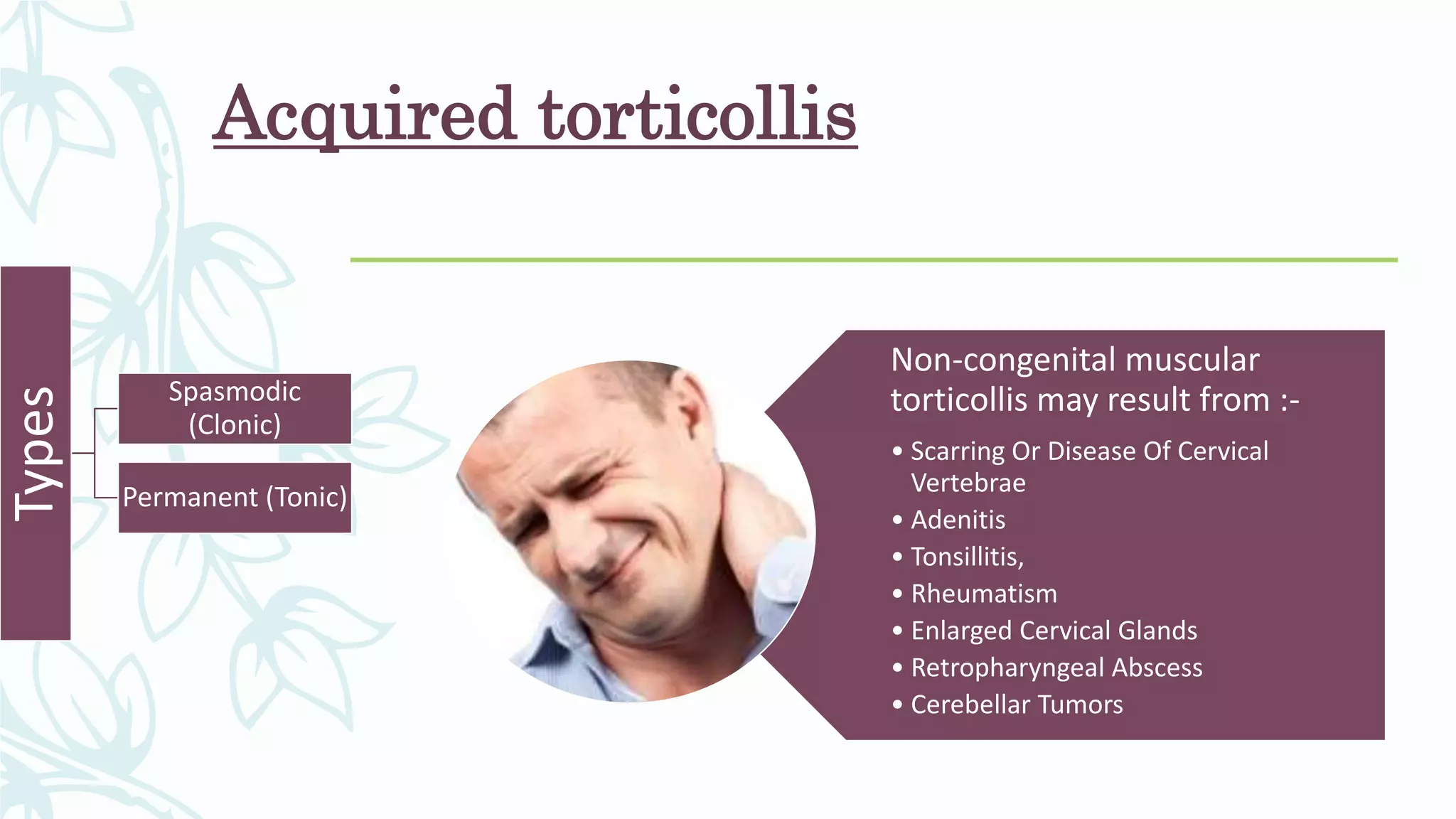 Torticollis and its P.T. Management | PPTX