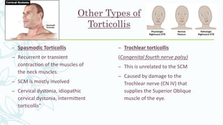 Torticollis and its P.T. Management | PPTX