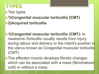 Torticollis | PPTX