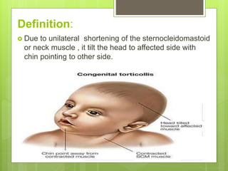 Torticollis | PPT
