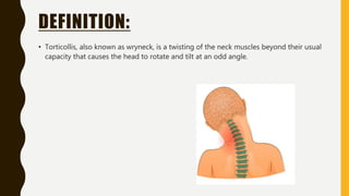 Torticollis | PPTX