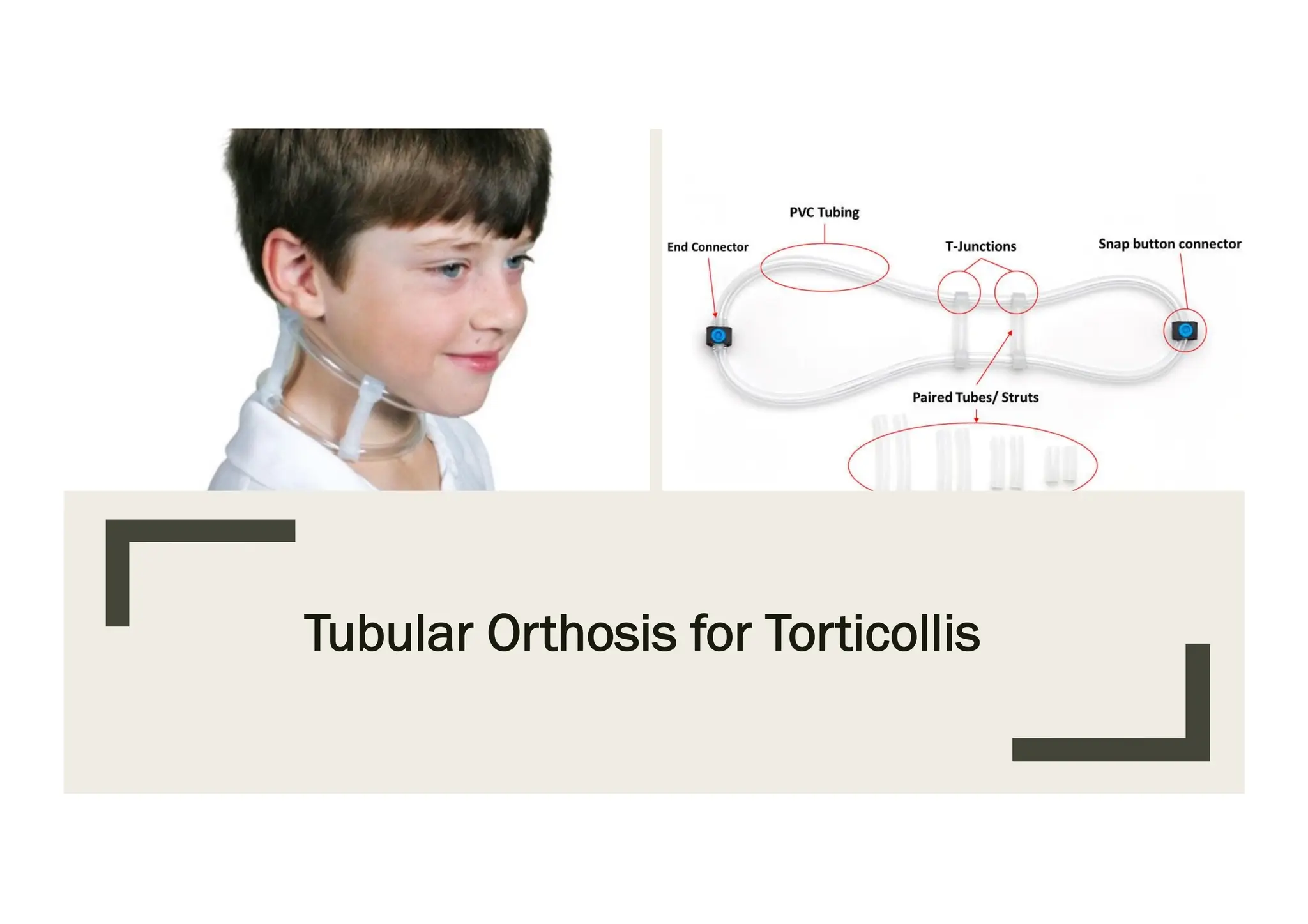 Torticollis Physiotherapy For Pediatrics Pdf