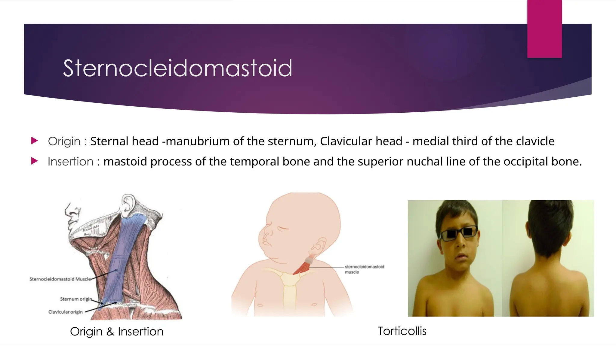 Torticollis / Wry Neck PT Management.pptx