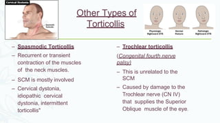 torticollis- cervical rib.pptx