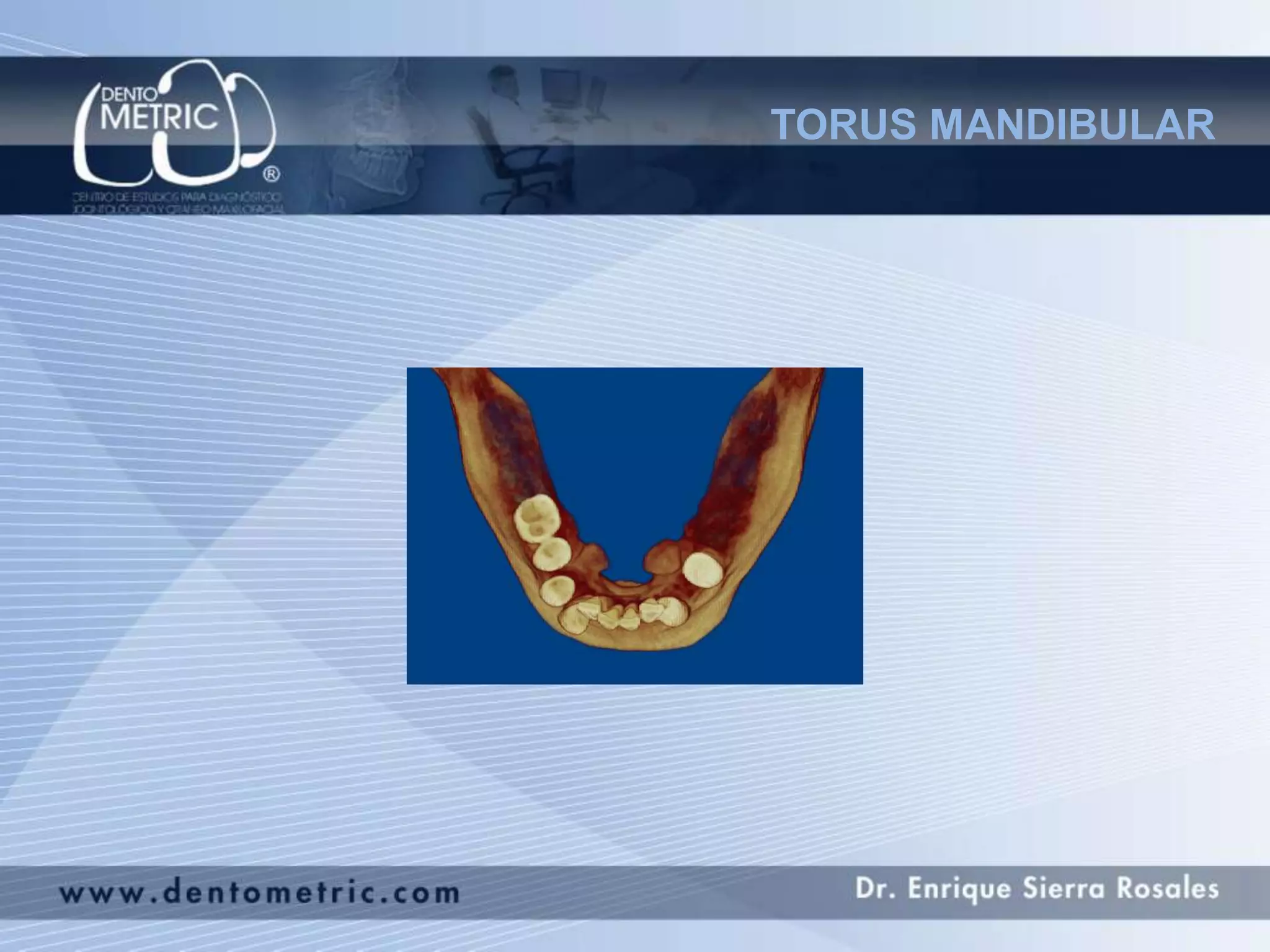 Torus mandibular | PPTX