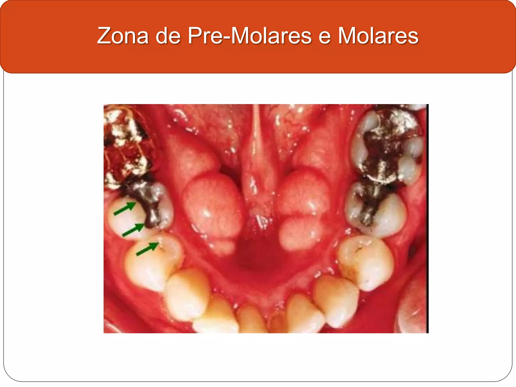 Torus mandibular | PPTX | Bone and Joint Conditions | Diseases and ...
