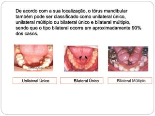 Torus mandibular | PPTX