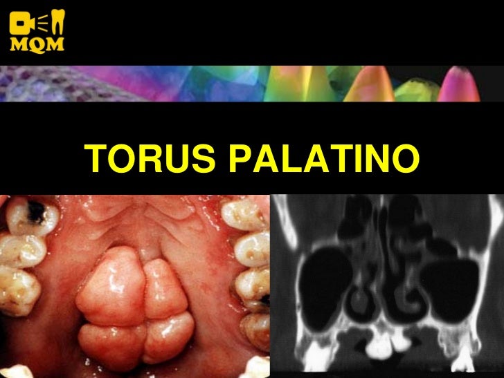 Torus Palatino