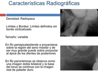 Torus palatino y mandibular | PPTX