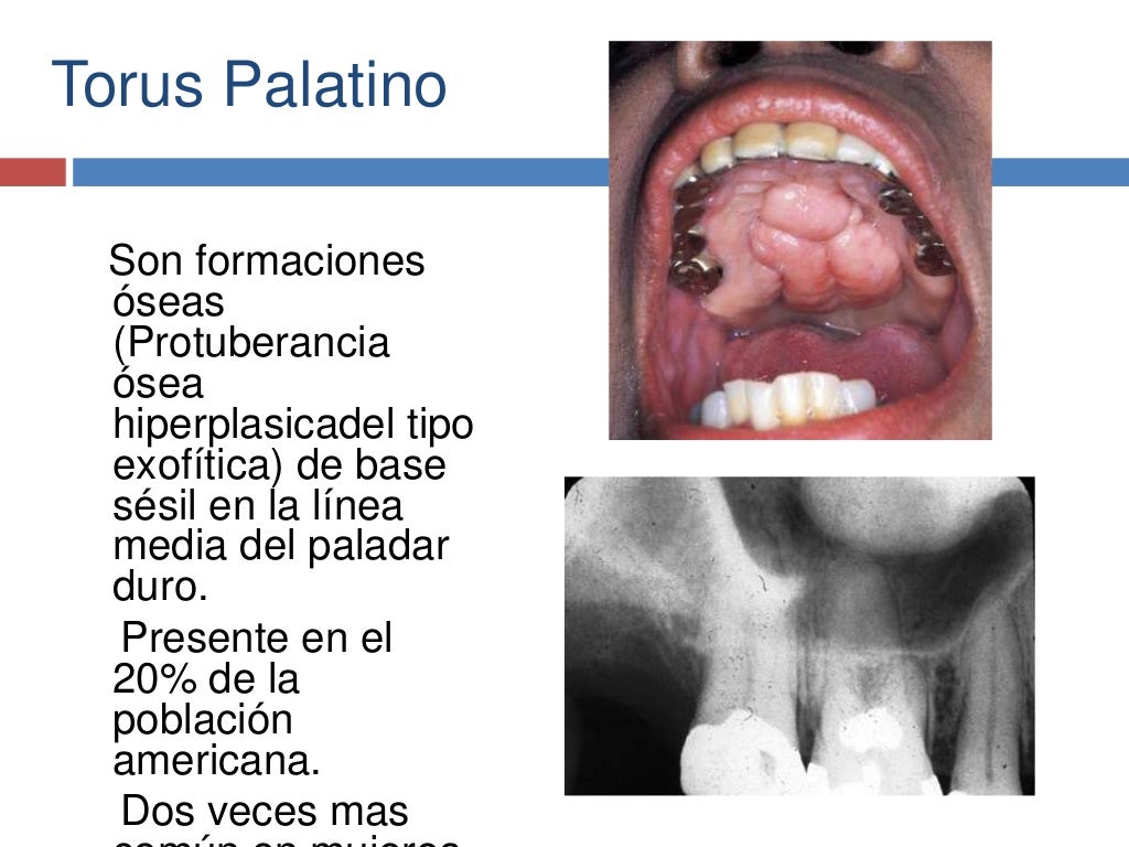 Torus Palatino E Mandibular - RETOEDU