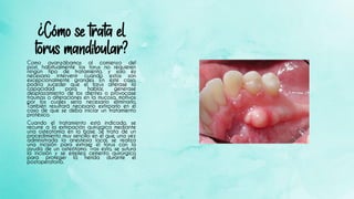 Torus palatino y mandibular | PDF