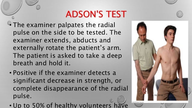 Addisons Test Thoracic Outlet Syndrome