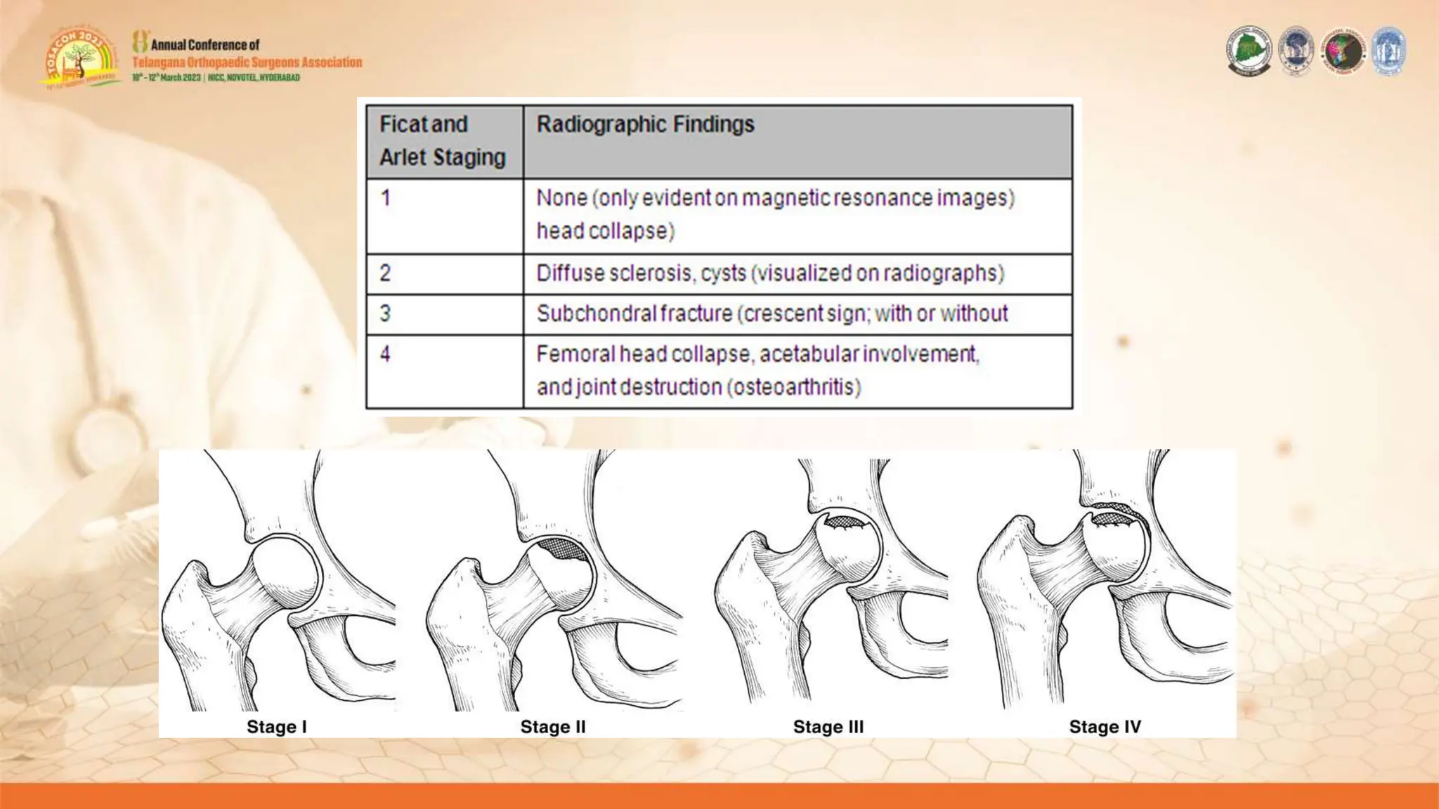 A study of core decompression & free fibular strut grafting in the management of Ficat-Arlet ...