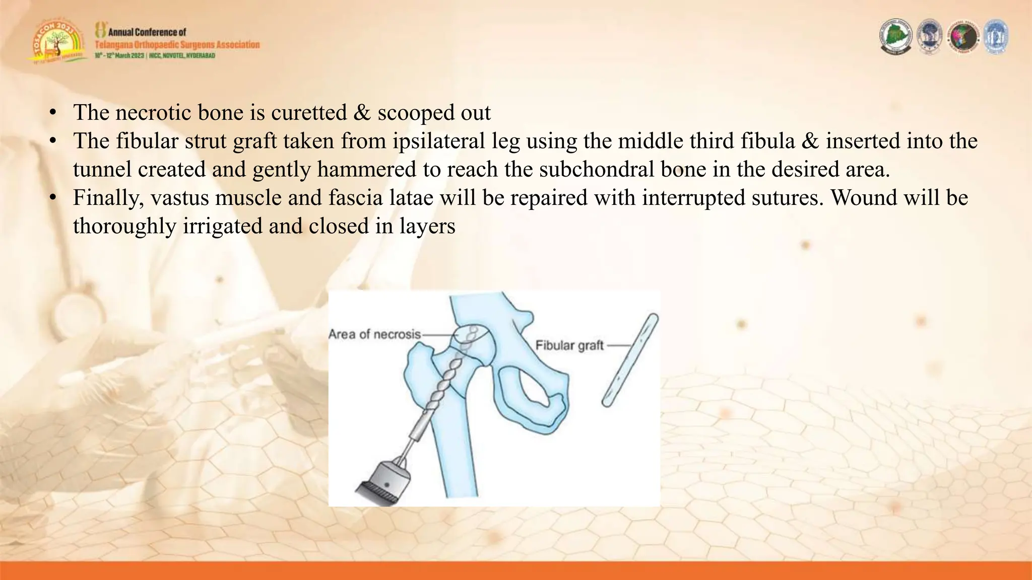 A study of core decompression & free fibular strut grafting in the management of Ficat-Arlet ...