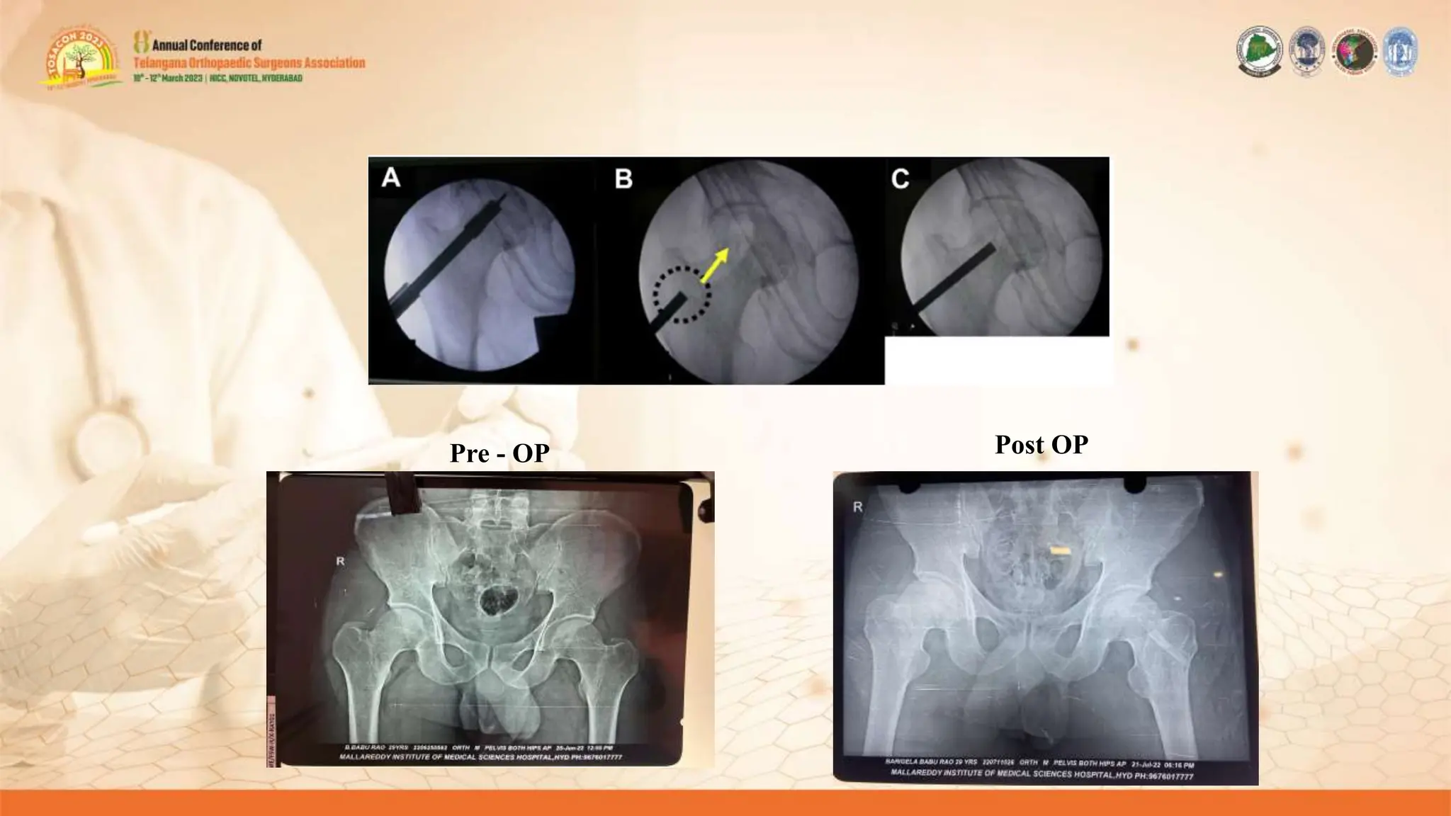 A study of core decompression & free fibular strut grafting in the ...