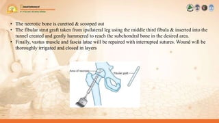A study of core decompression & free fibular strut grafting in the ...