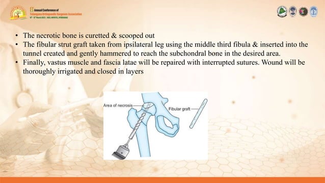 A study of core decompression & free fibular strut grafting in the ...