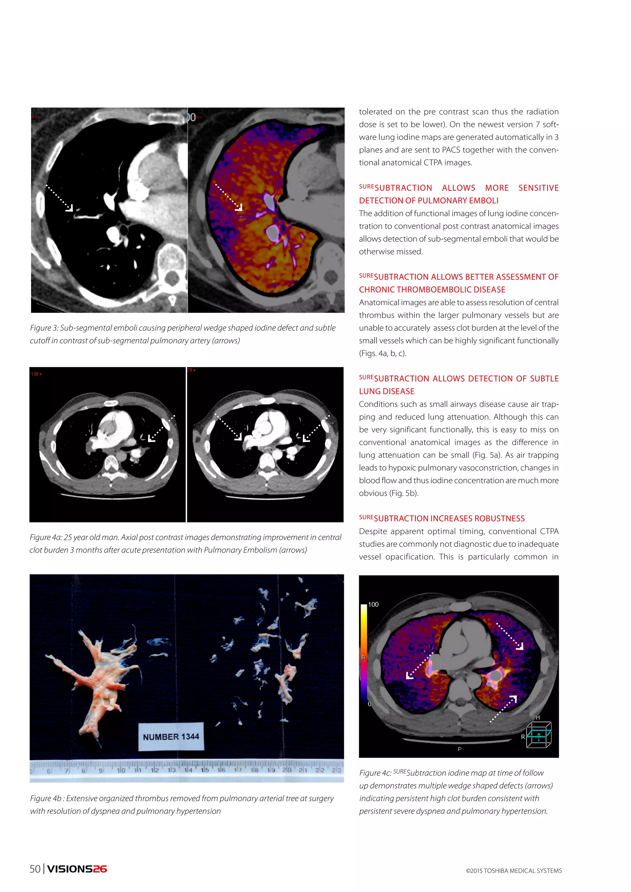 Lung SURESubtraction in Everyday Practice - Dr R. Bull | PDF