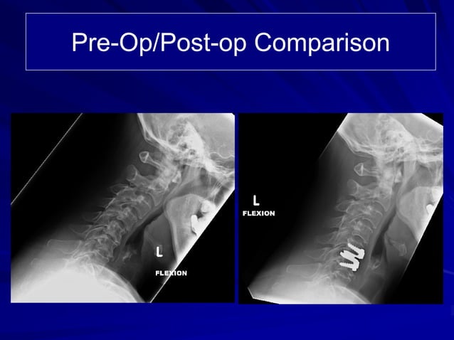 Case Review #7: 51 year old female with Prestige Cervical Disc ...