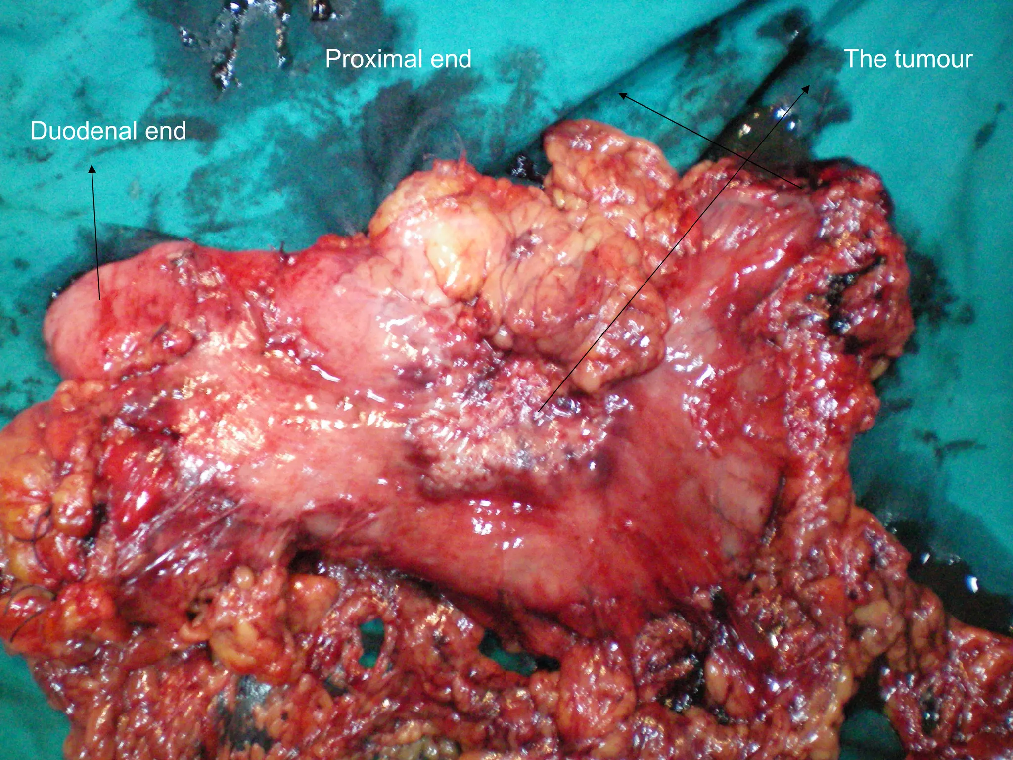 Total Gastrectomy 4 | PPT