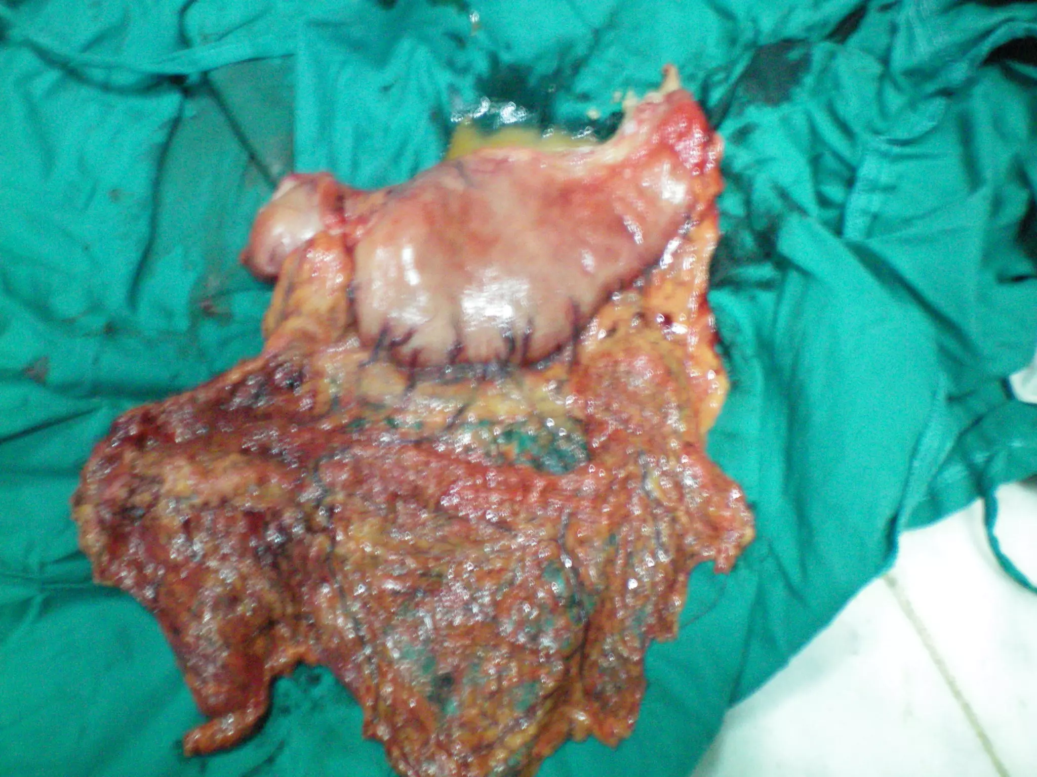 Total Gastrectomy 4 | PPT