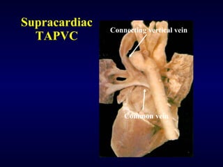Total Anomalous Pulmonary Venous Connection | PPT