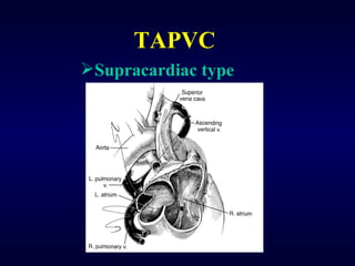 Total Anomalous Pulmonary Venous Connection | PPT