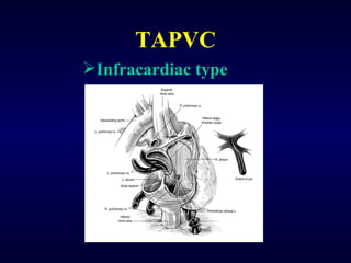 Total Anomalous Pulmonary Venous Connection | PPT