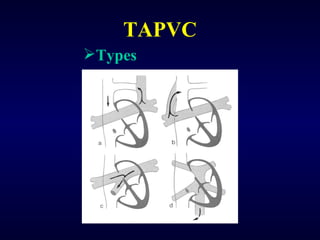 Total Anomalous Pulmonary Venous Connection | PPT