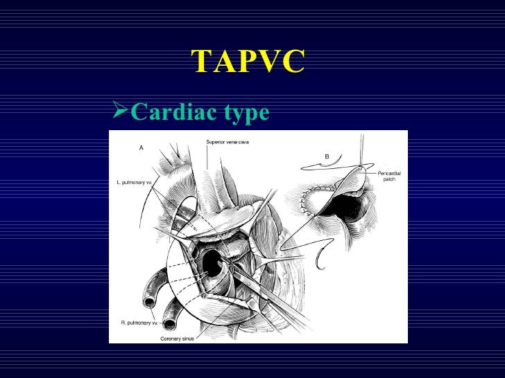 Total Anomalous Pulmonary Venous Connection