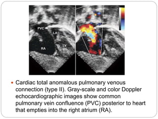 Total anomalous pulmonary venous connection | PPTX