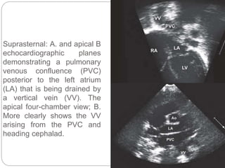 Total anomalous pulmonary venous connection | PPTX