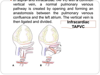 Total anomalous pulmonary venous connection | PPTX