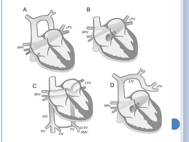 TOTAL ANOMALOUS PULMONARY VENOUS CONNECTION (TAPVC) | PPT | Lung and ...